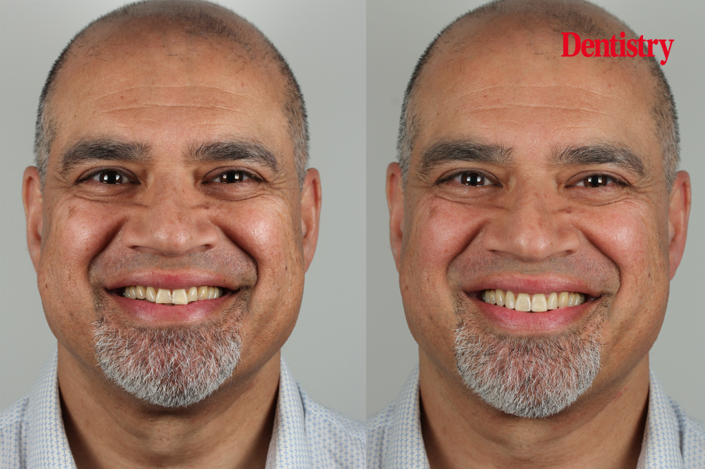 Patient delighted with 'age-defying' composite bonding - Dentistry