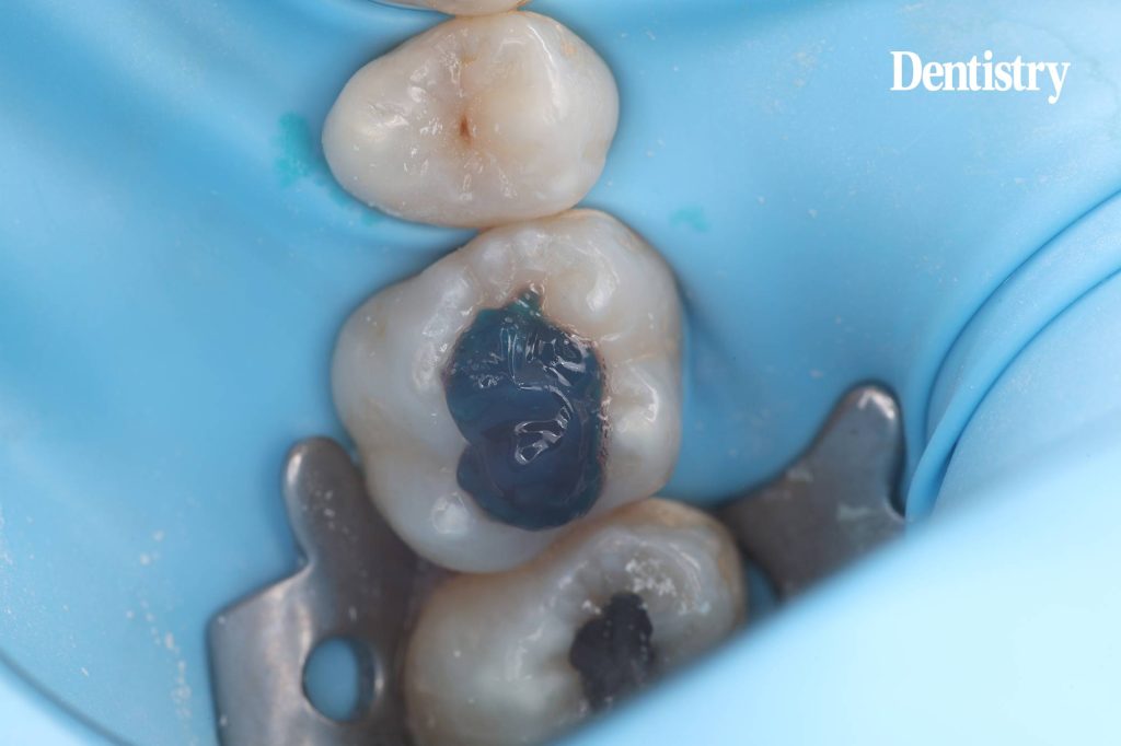 The 'Stamp Technique': revolutionising restorations - Dentistry