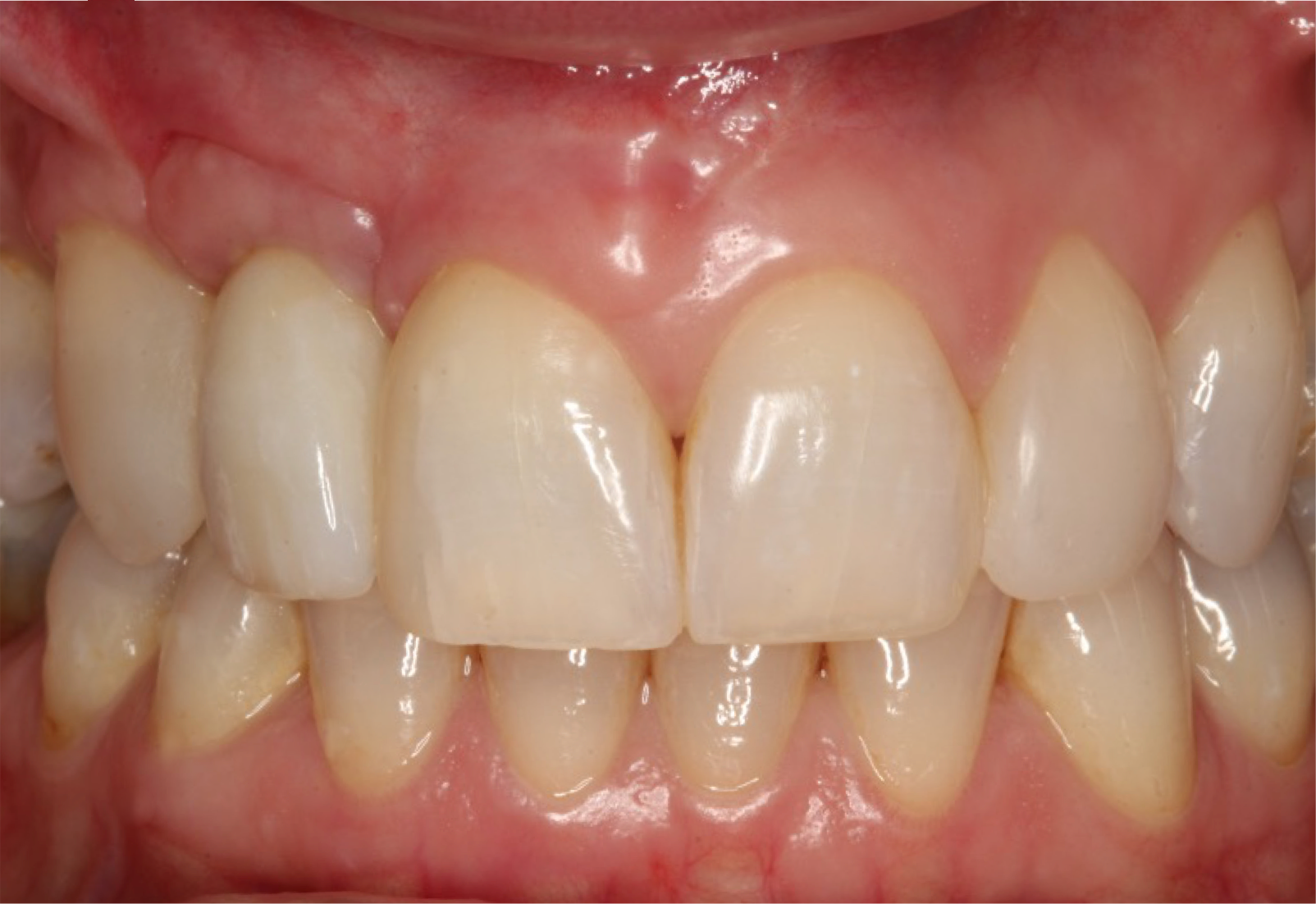 Case study: how to promote guided bone regeneration - Irish Dentistry