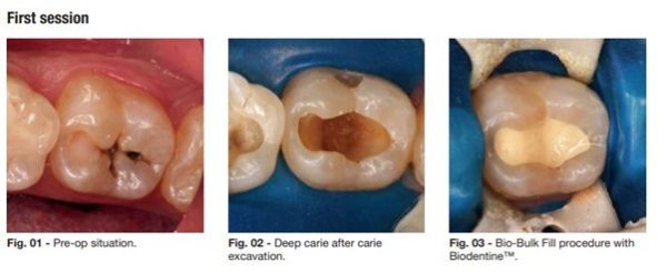 Deep caries management using bio-bulk procedure - Dentistry