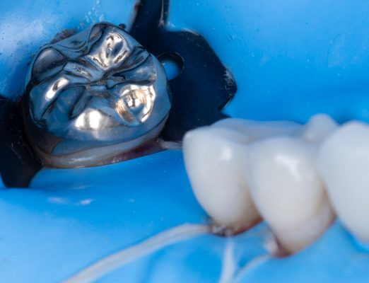 Panavia V5 cement – all you need for all you do - Dentistry