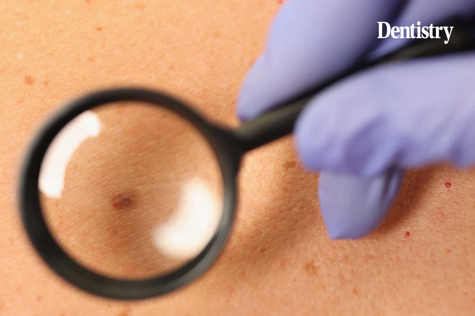 Skin cancer cases in UK reach record high - Dentistry