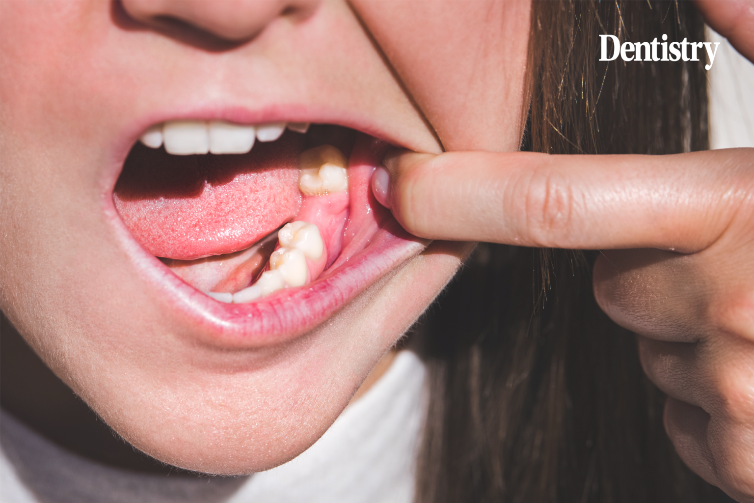 Tooth regrowth medicine successful in animal trials - Dentistry