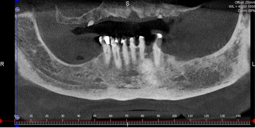 The 'all-on-four' concept restoration on lower jaw - Dentistry