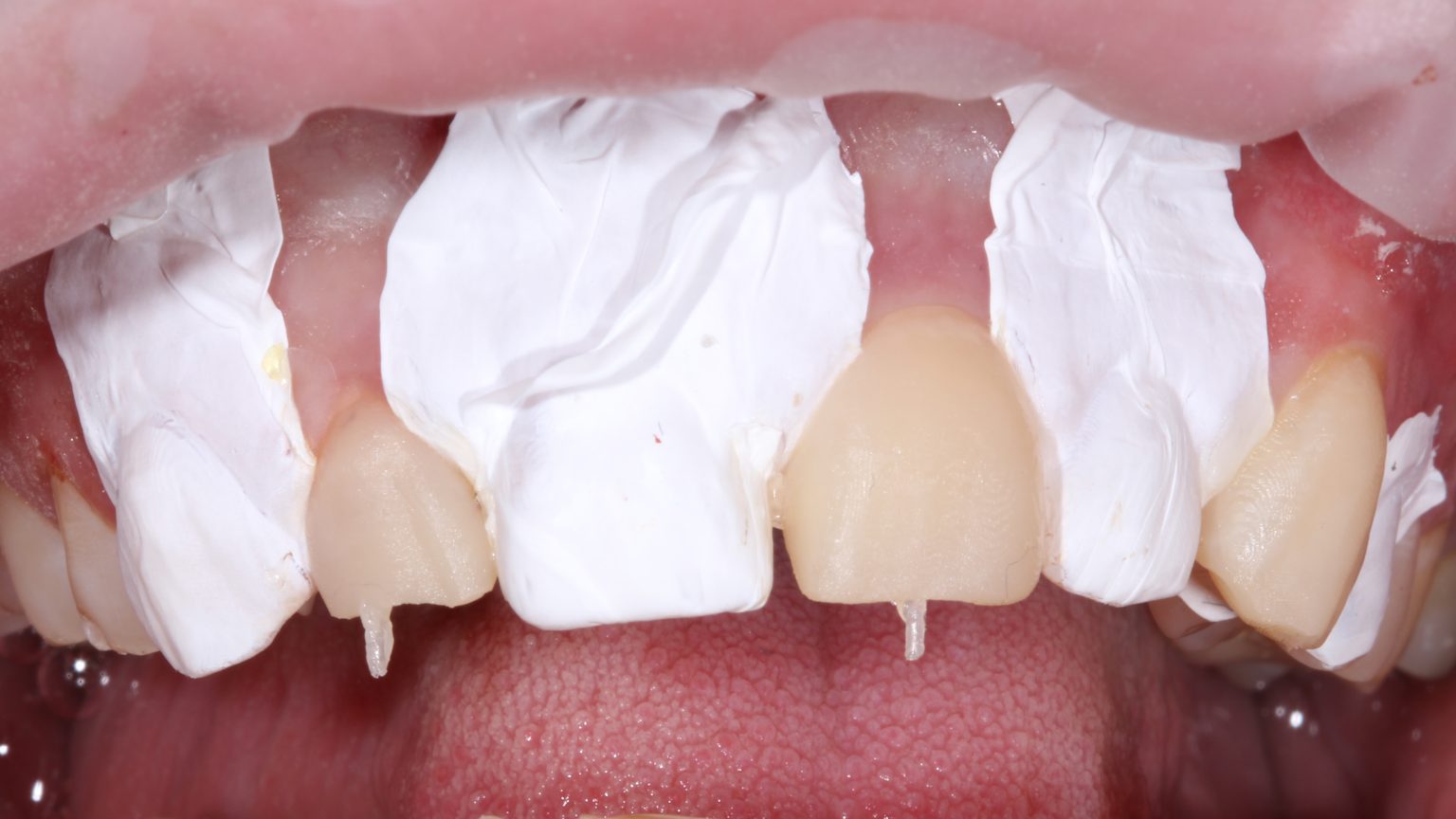 Managing gastroesophageal reflux disorder (GORD) - Dentistry