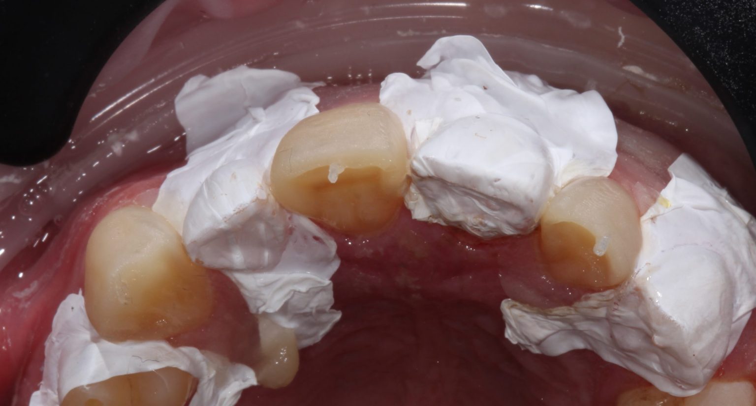 Managing gastroesophageal reflux disorder (GORD) - Dentistry