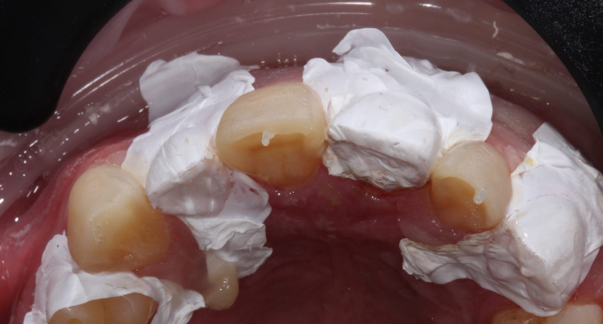 Managing gastroesophageal reflux disorder (GORD) - Dentistry