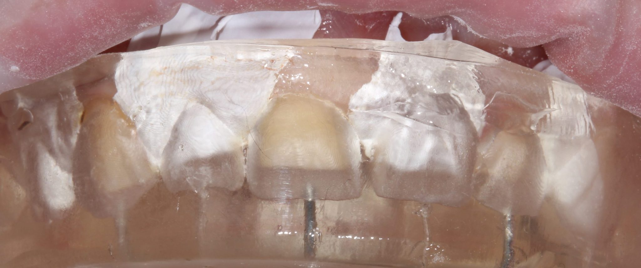 Managing gastroesophageal reflux disorder (GORD) - Dentistry