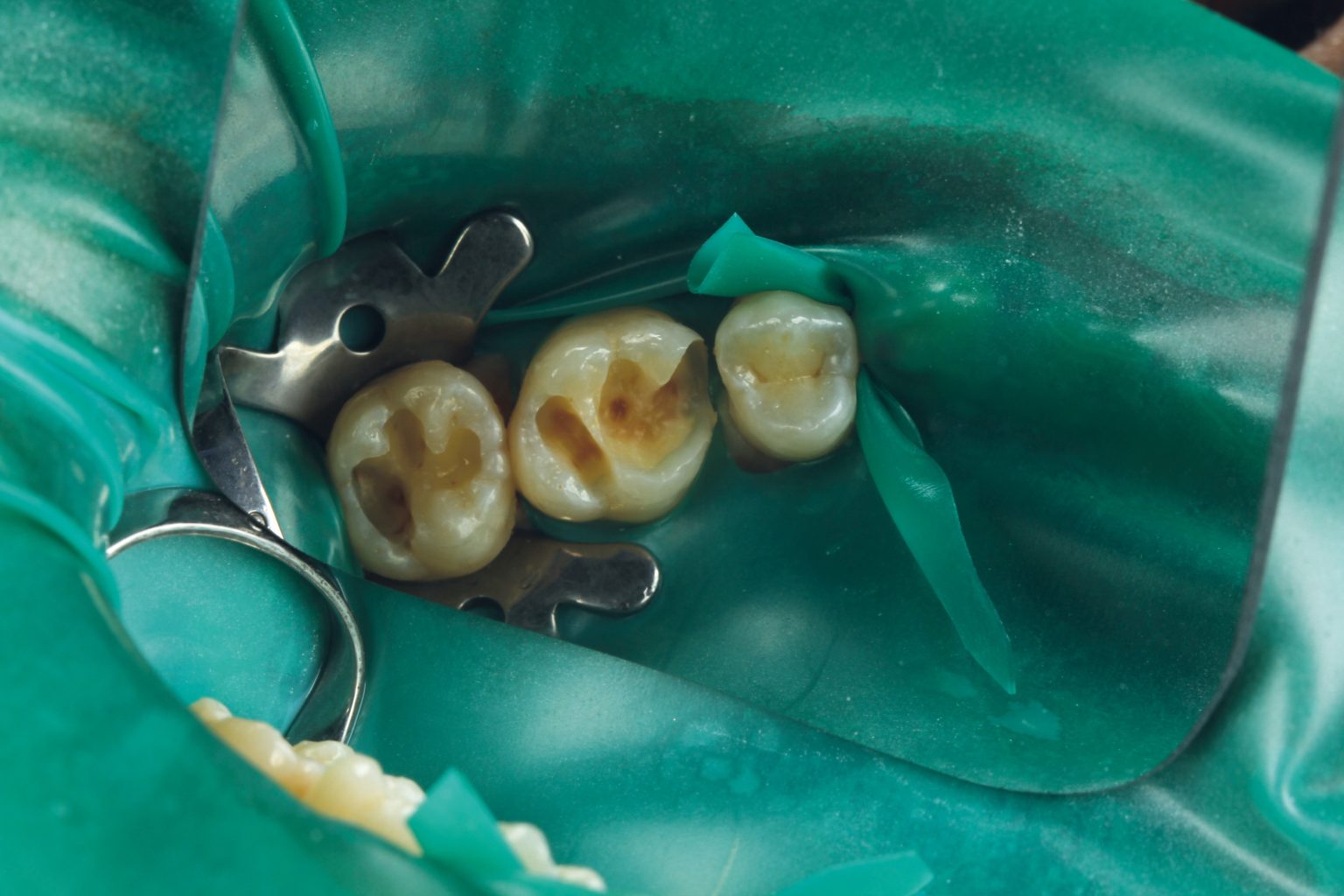 A step-by-step guide to managing caries - Dentistry