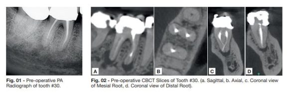 Successful root canal re-treatment with BioRoot Flow - Dentistry