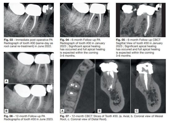 Successful root canal re-treatment with BioRoot Flow - Dentistry