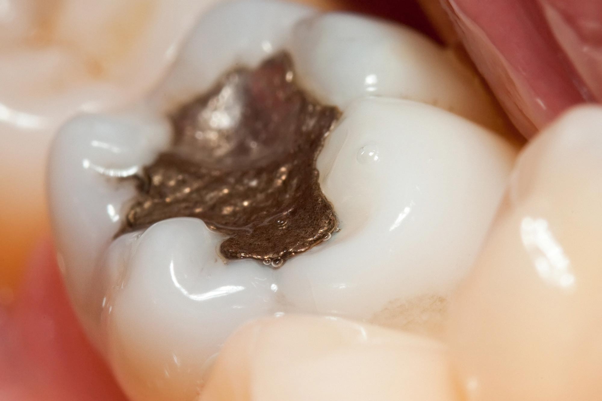 dental-amalgam-homepage - Dentistry.co.uk