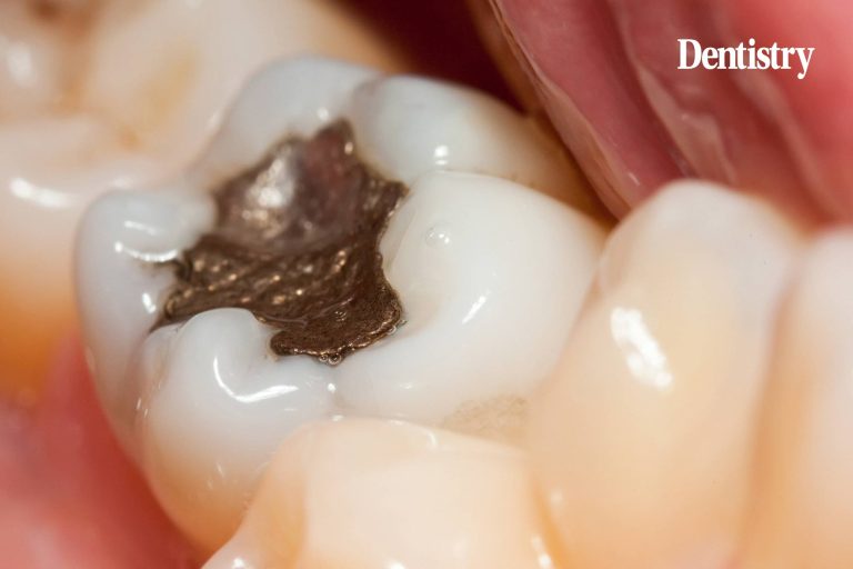 Dental amalgam – everything you need to know - Dentistry