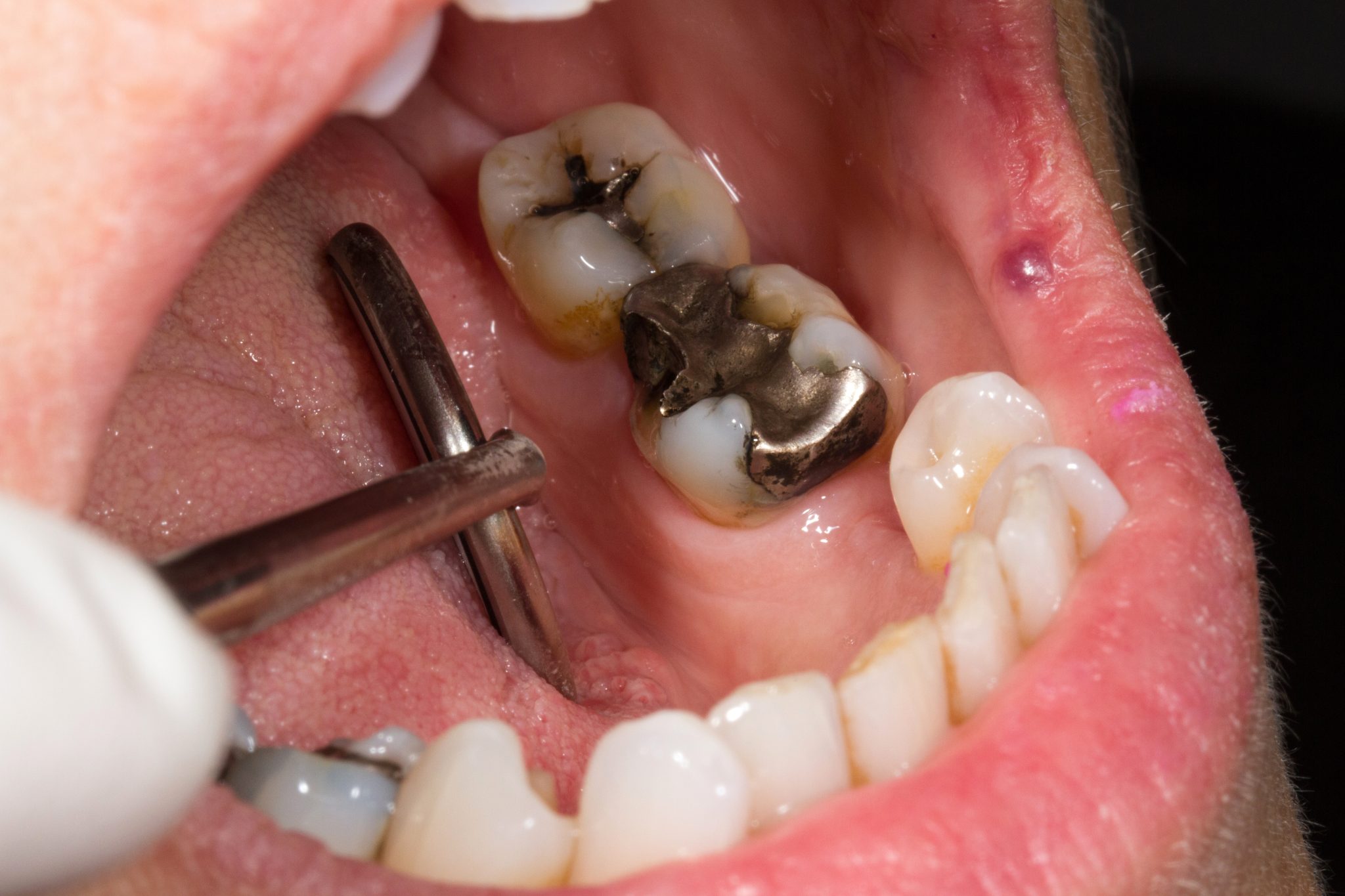 Dental amalgam – everything you need to know - Dentistry