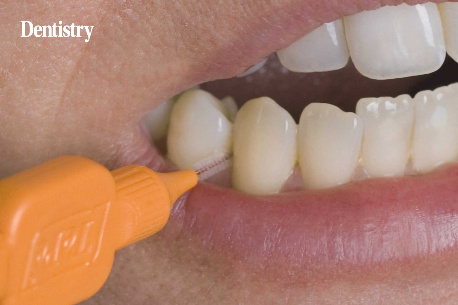 The importance of interdental cleaning - Dentistry