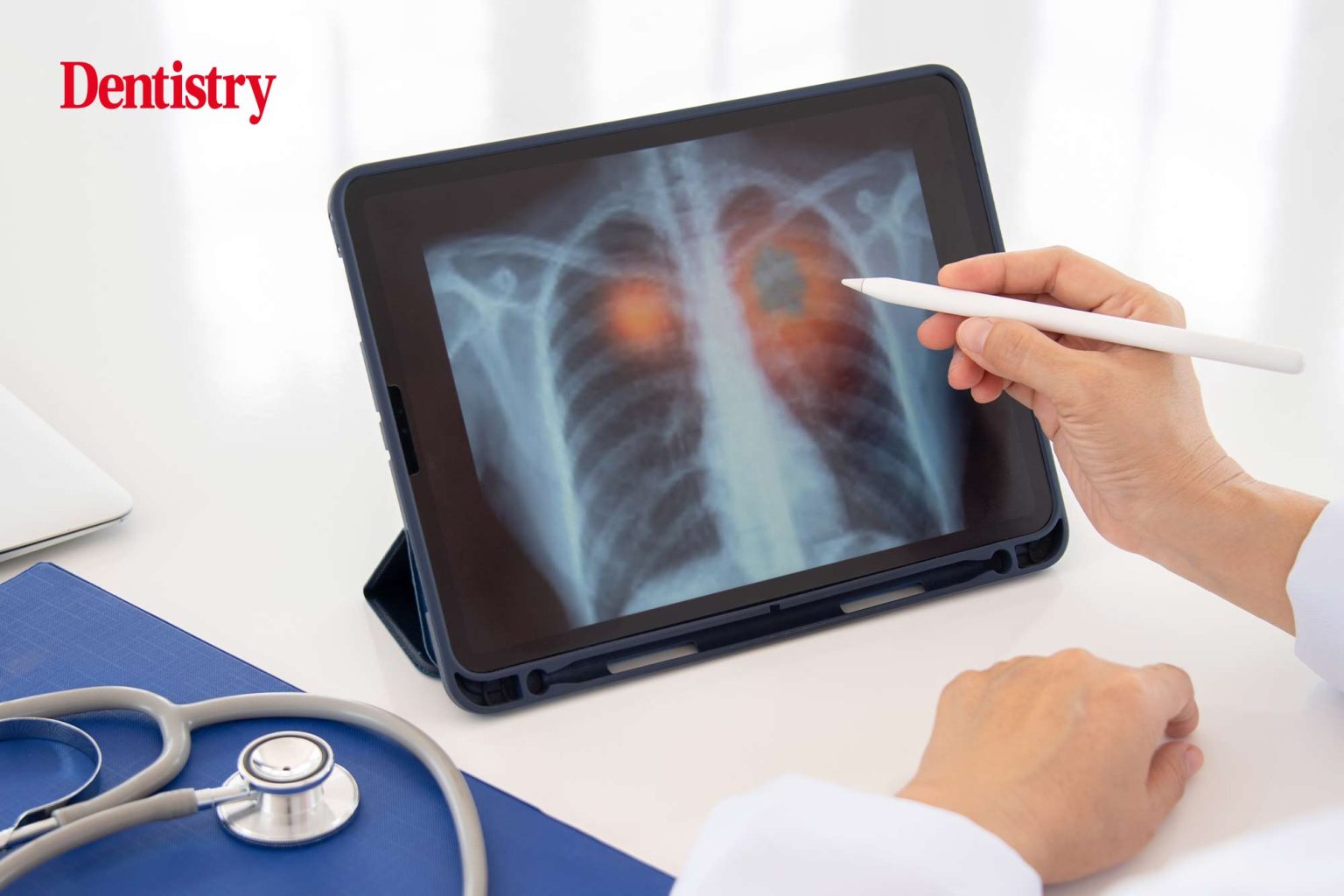 Lung cancer in non-smokers on the rise - Dentistry