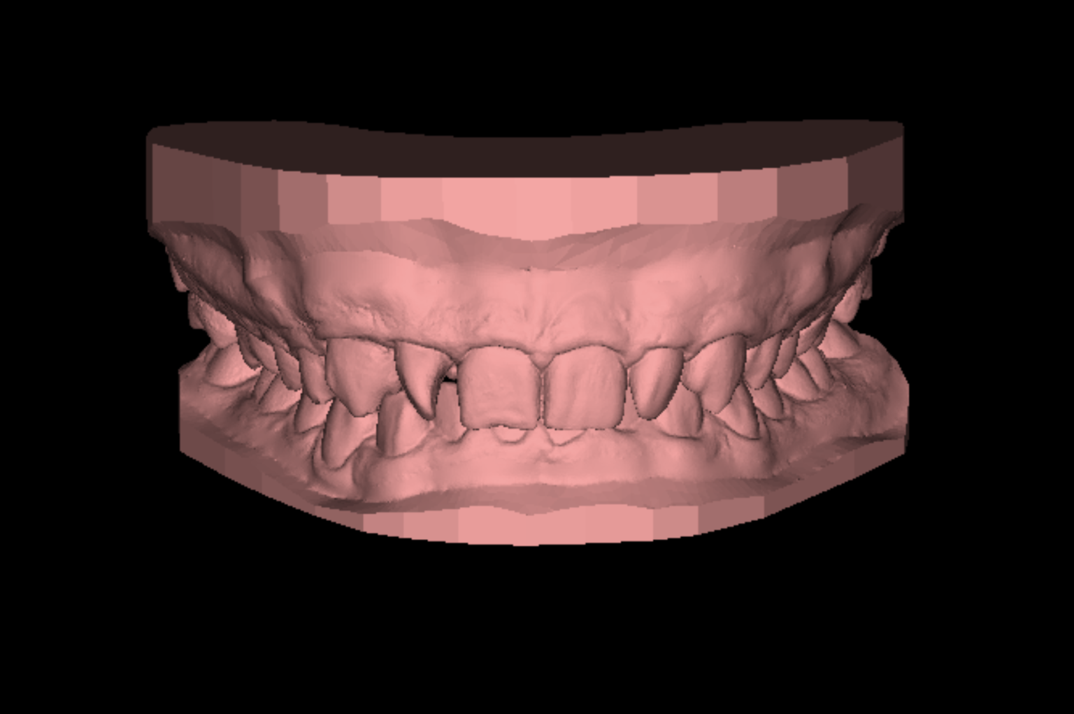 Smile makeover using digital fully guided workflows - Dentistry