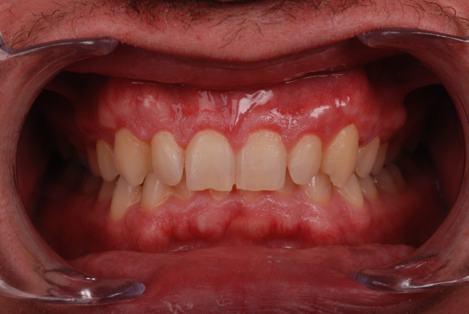 Smile makeover using digital fully guided workflows - Dentistry