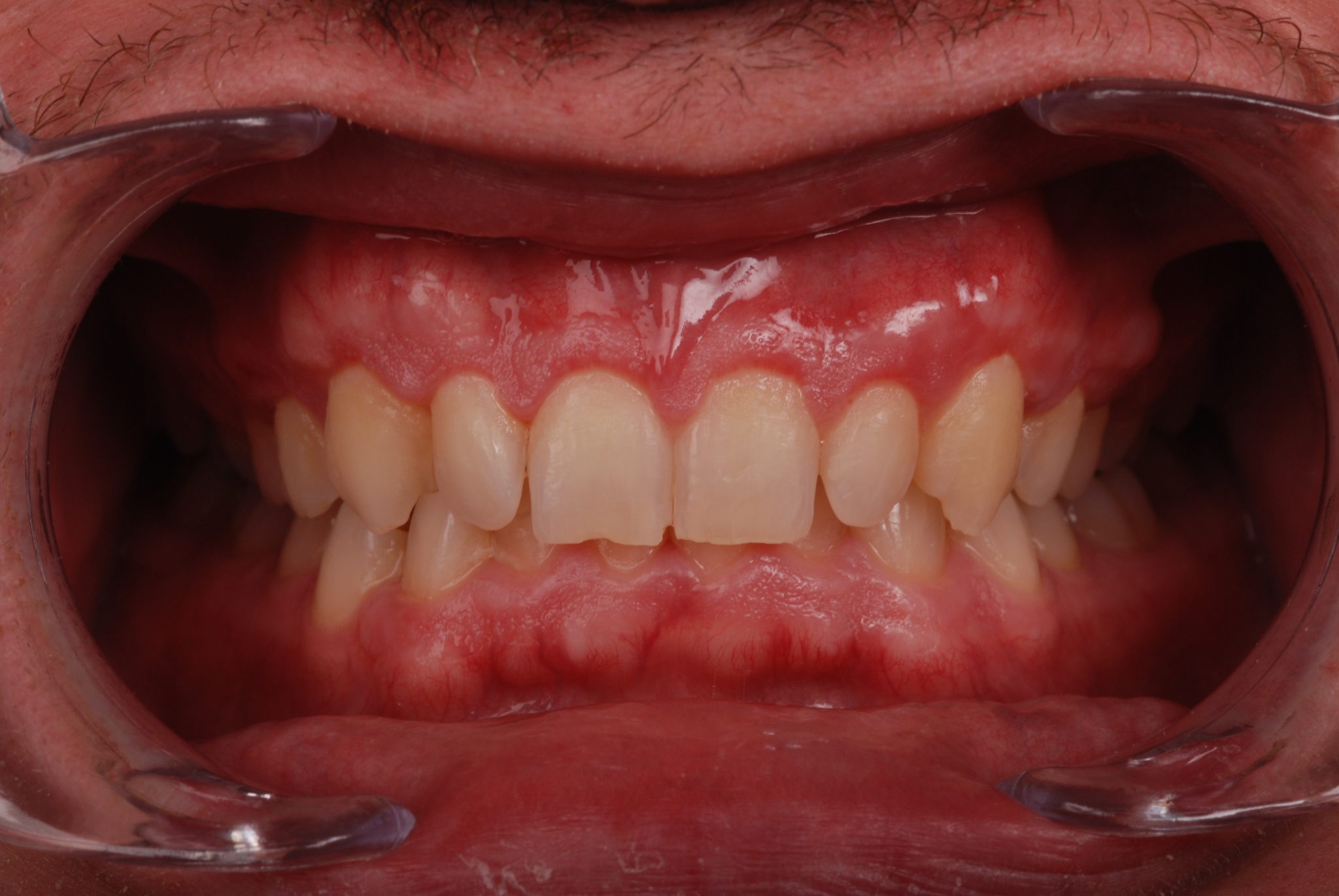 Smile makeover using digital fully guided workflows - Dentistry