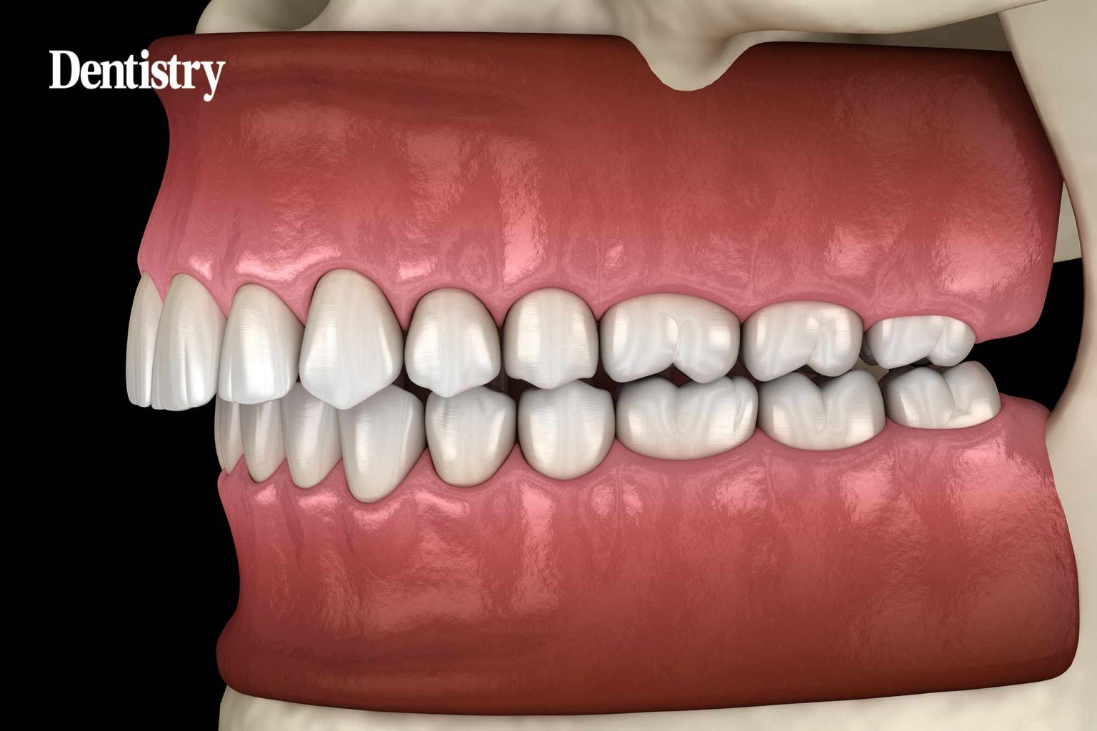 Managing class II malocclusion with Invisalign - Dentistry