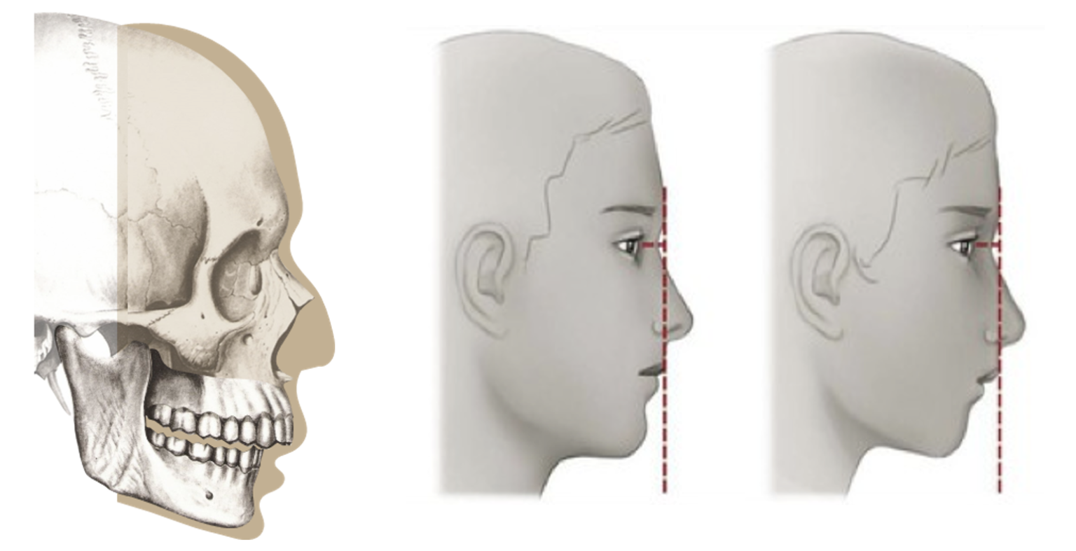 Managing class II malocclusion with Invisalign - Dentistry