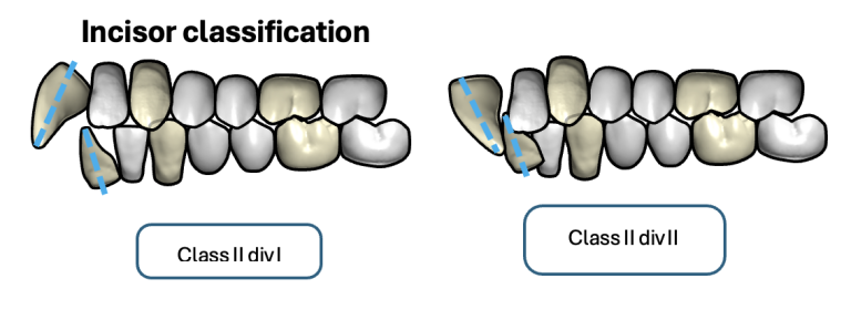 Managing class II malocclusion with Invisalign - Dentistry