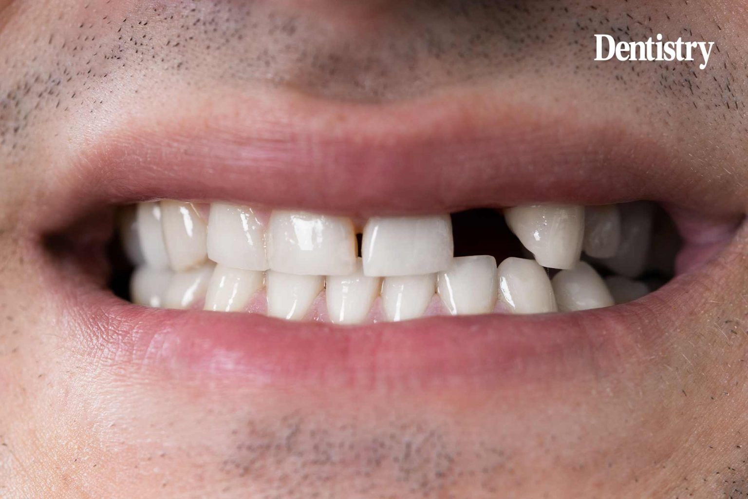 Lab-grown teeth one step closer following new research - Dentistry