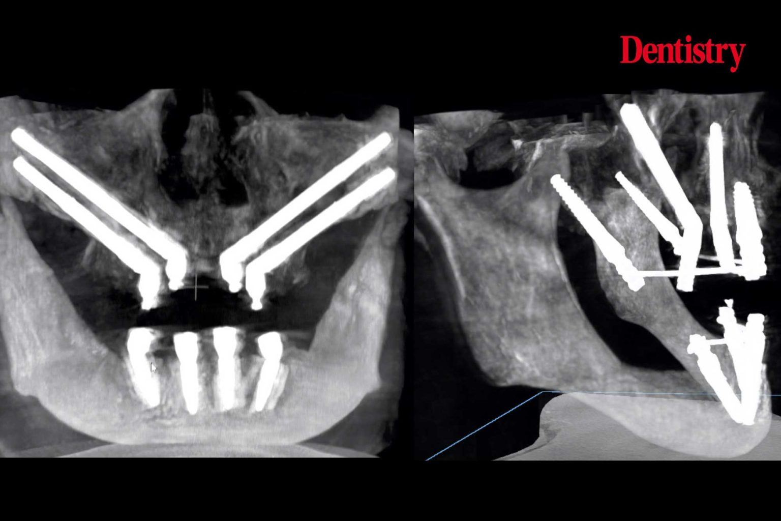 Zygomatic implants in the atrophic maxilla – Dentistry