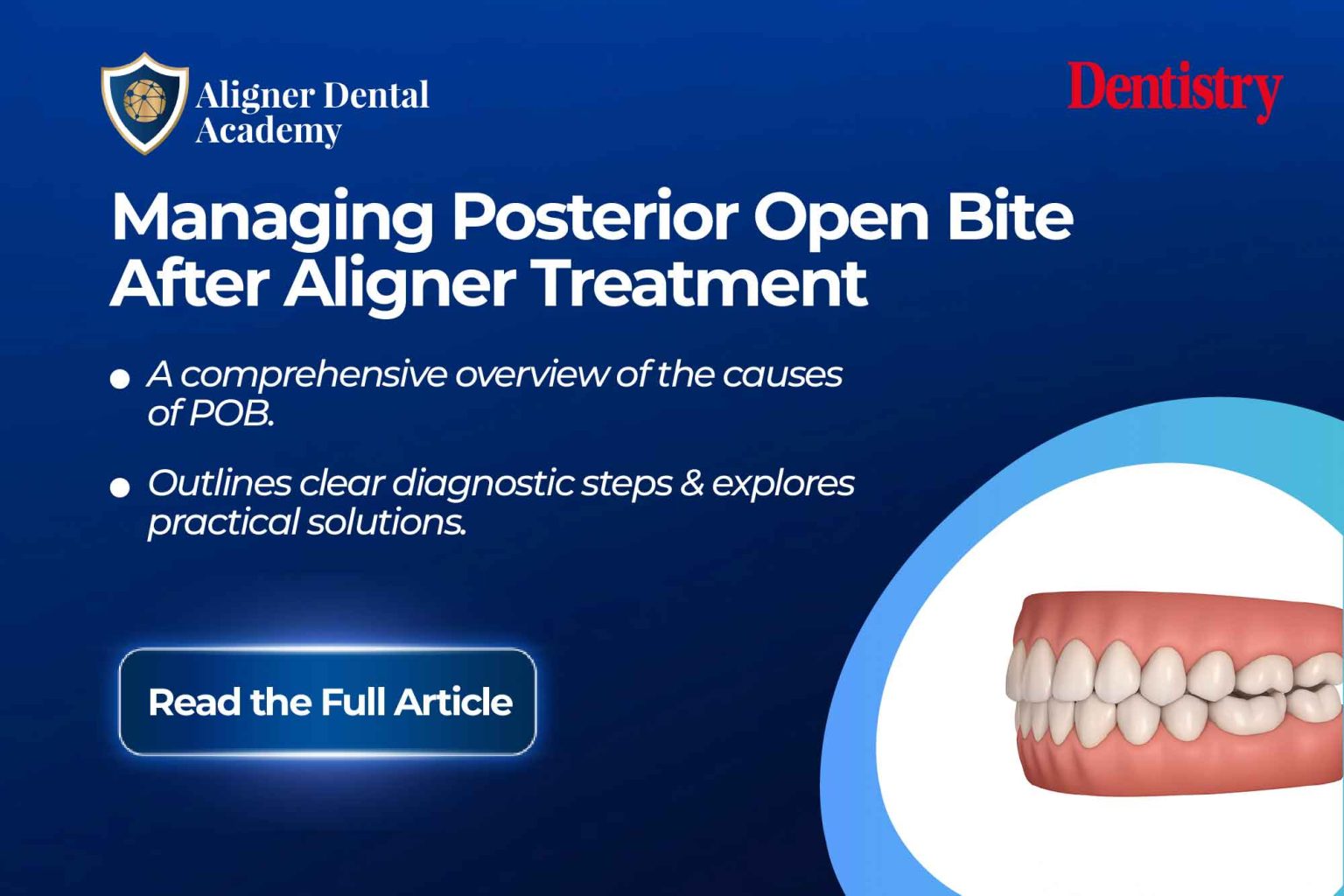 Managing posterior open bite after aligner therapy - Dentistry