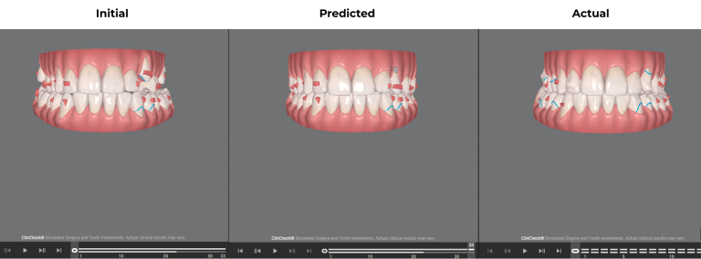 Predictable single-tooth extrusion with Invisalign - Dentistry
