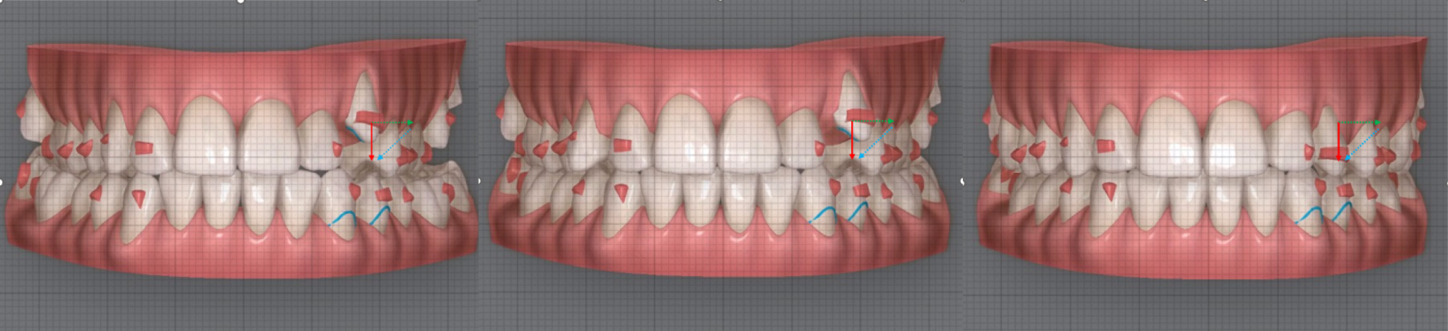 Predictable single-tooth extrusion with Invisalign - Dentistry