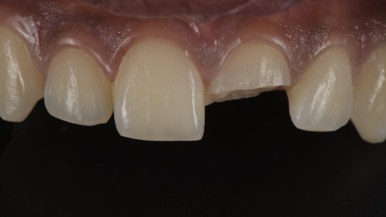 Anterior trauma with limited inter-occlusal space - Dentistry