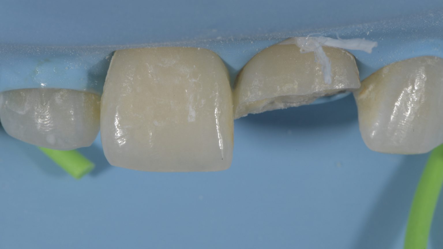 Anterior trauma with limited inter-occlusal space - Dentistry
