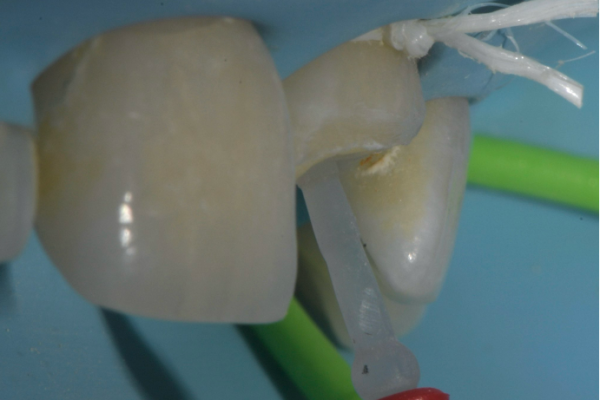 Picture 1-tooth - Dentistry.co.uk