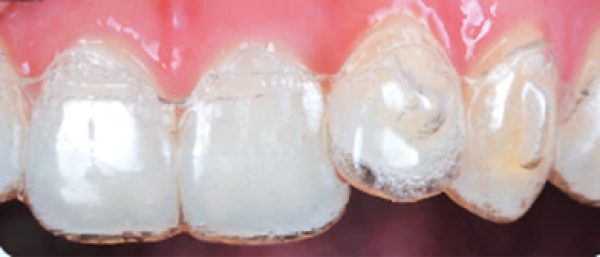 Controlling upper lateral incisors with aligners - Dentistry