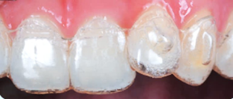 Controlling upper lateral incisors with aligners - Dentistry