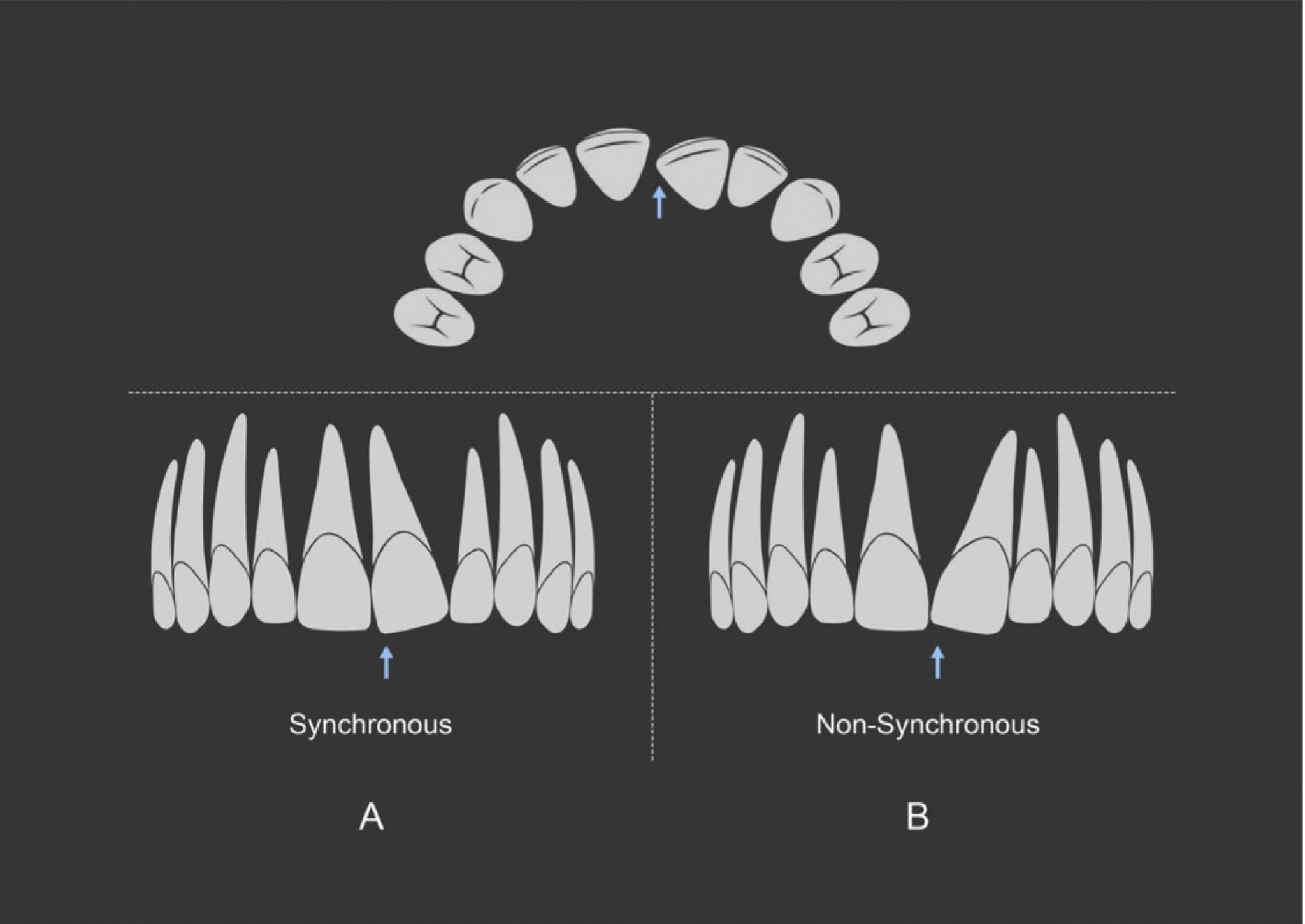 Controlling upper lateral incisors with aligners - Dentistry