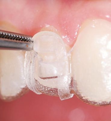 Controlling upper lateral incisors with aligners - Dentistry