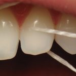 Controlling upper lateral incisors with aligners - Dentistry