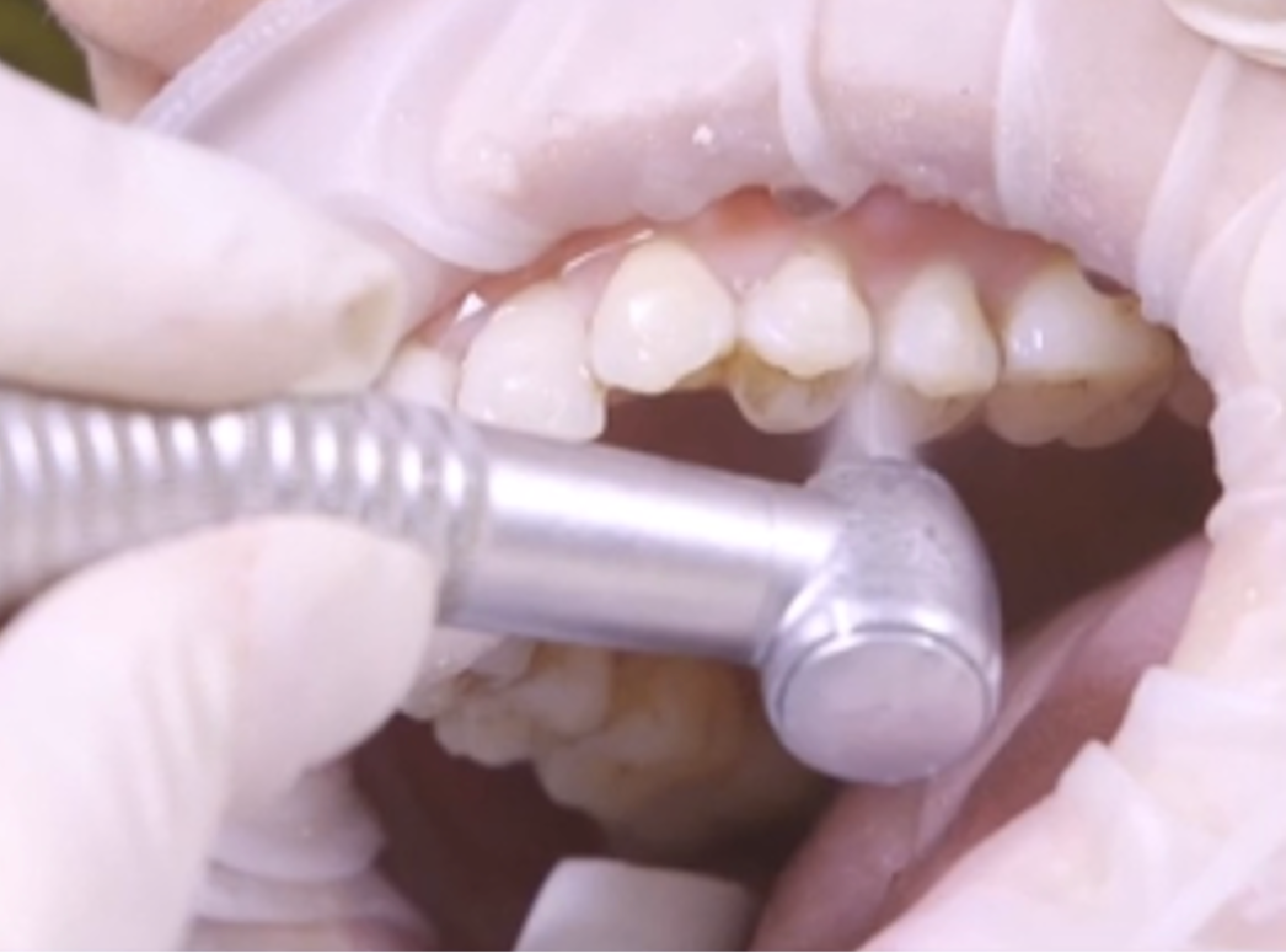 Interproximal reduction: optimising clear aligner treatment - Dentistry