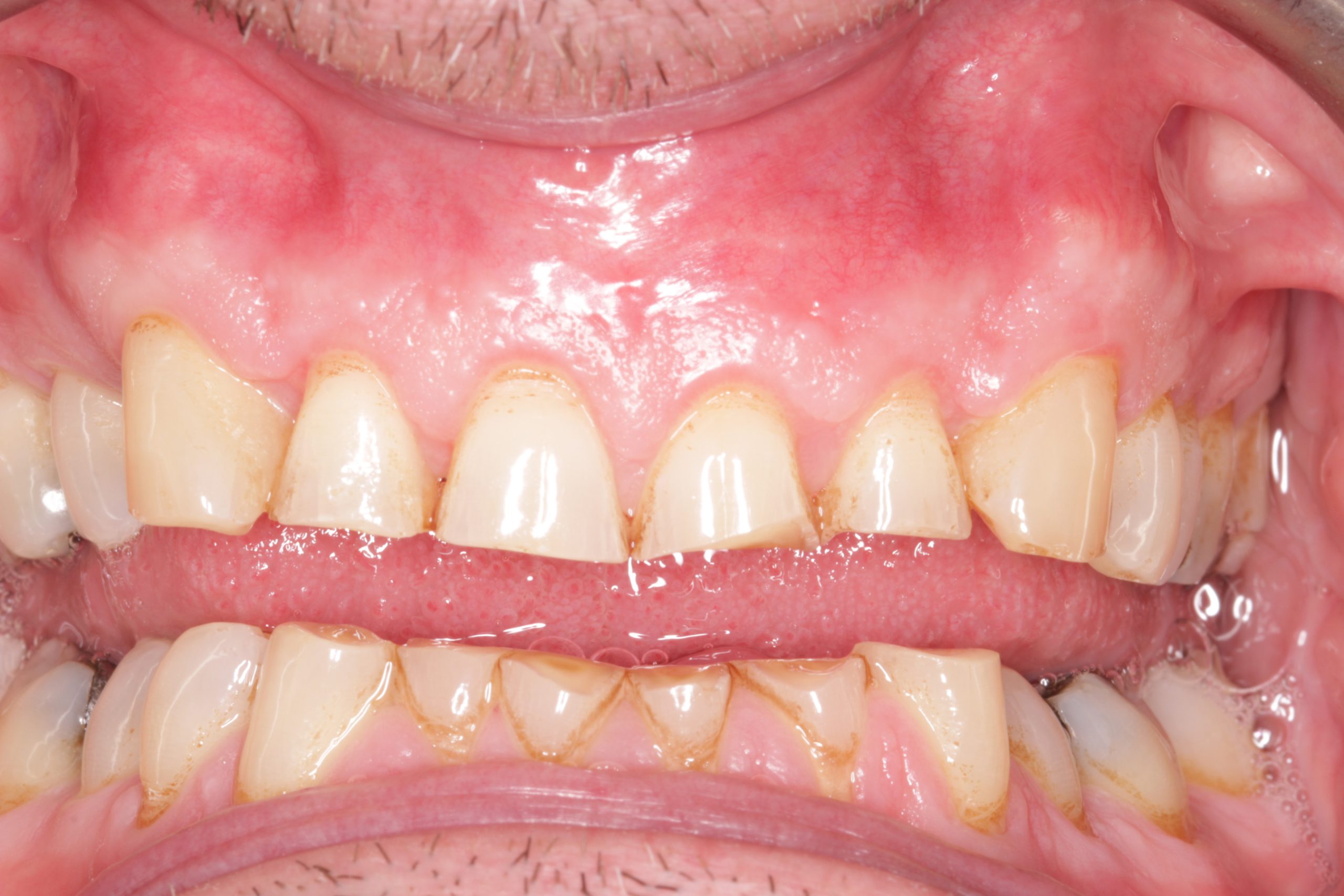 Front open bite - Dentistry.co.uk