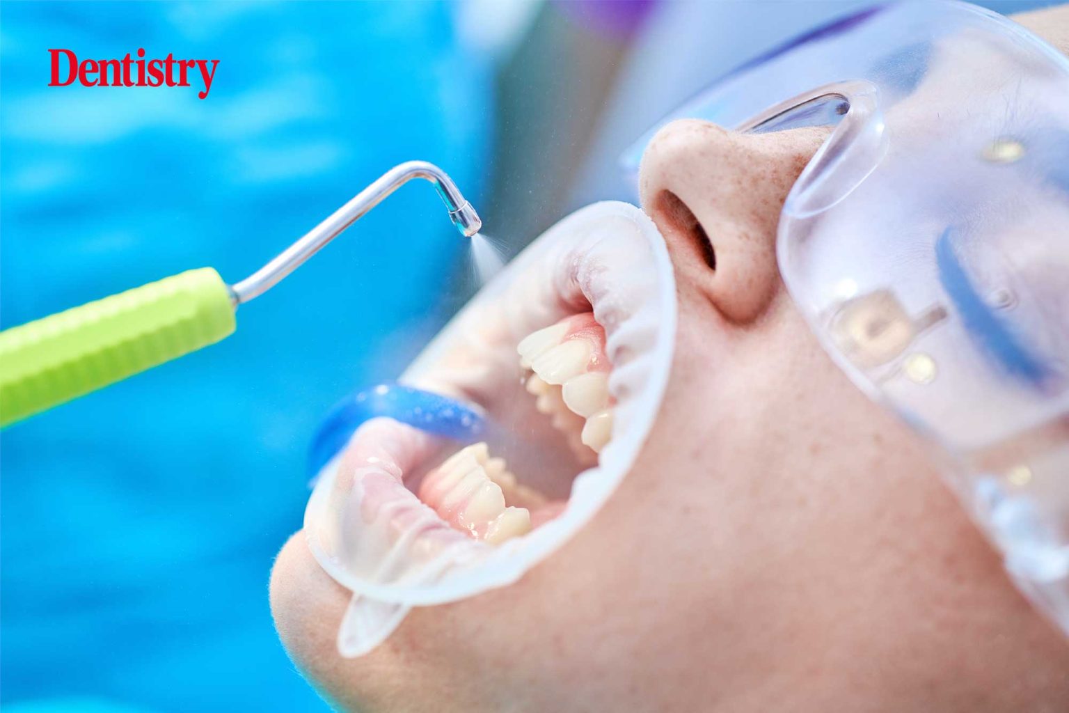 Air polishing: what dental professionals need to know - Dentistry