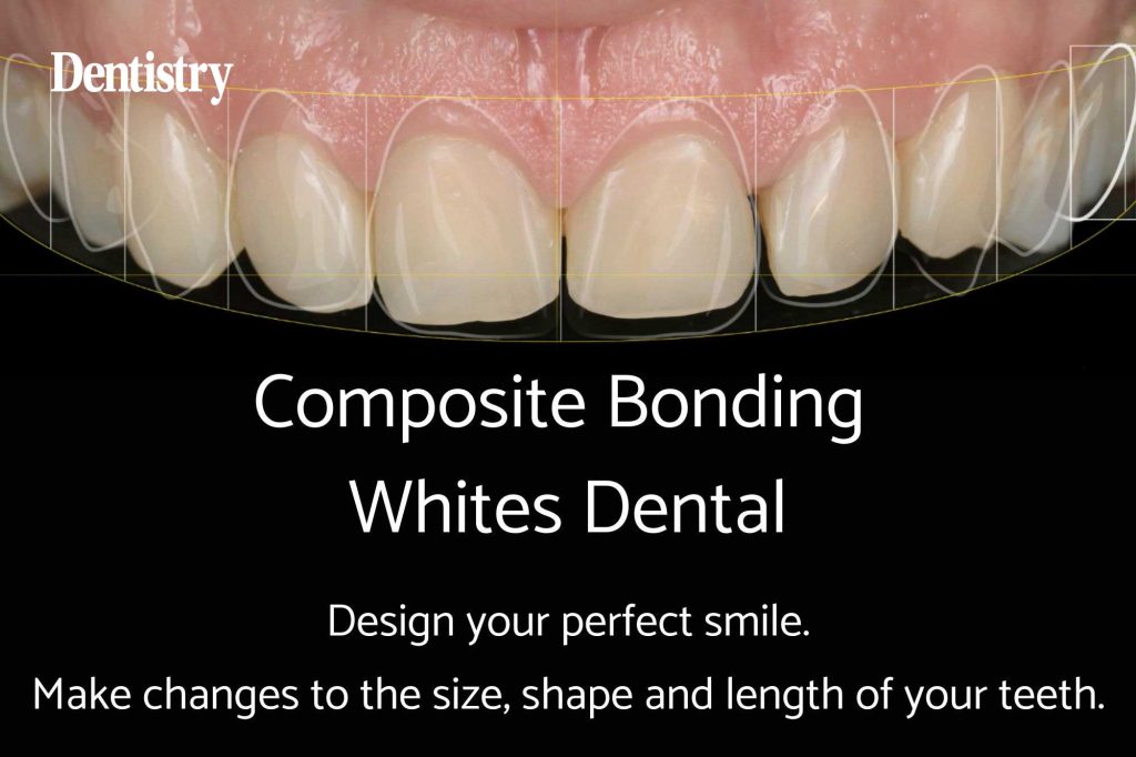 How composite bonding is changing smiles in London - Dentistry