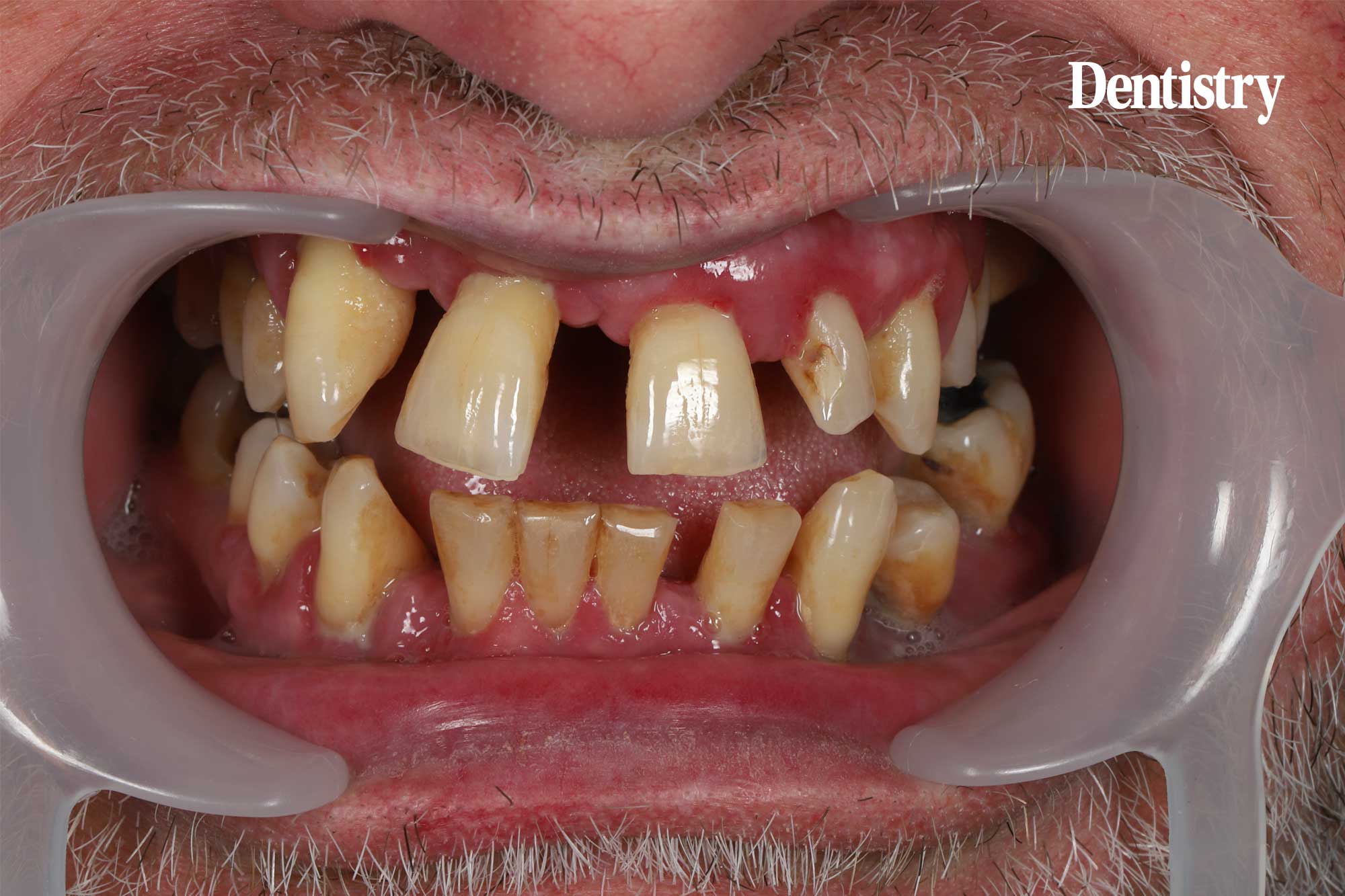Highlighting patient care in a complex implant case - Dentistry