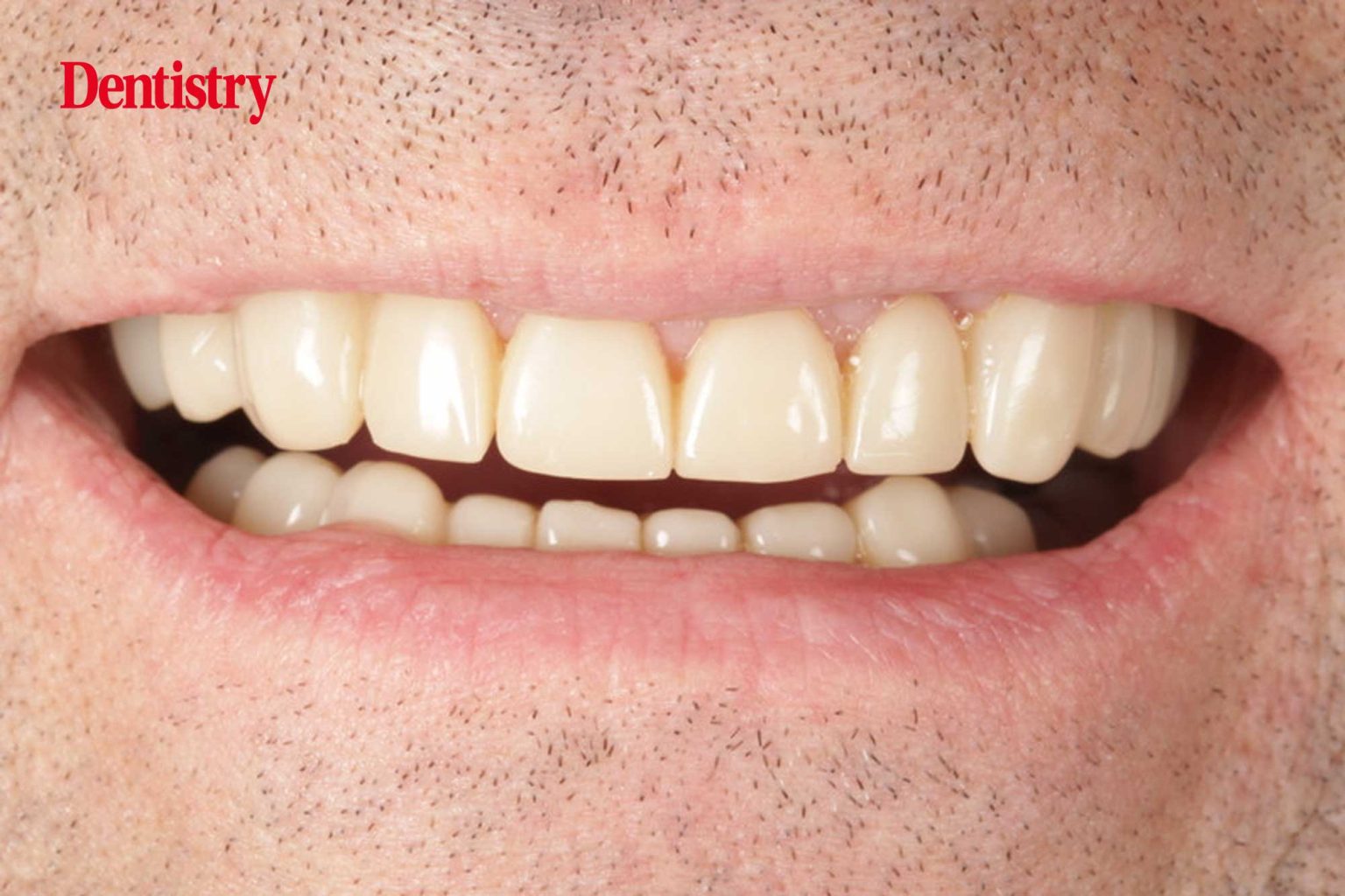 Full-mouth rehabilitation of a severe tooth wear case - Dentistry