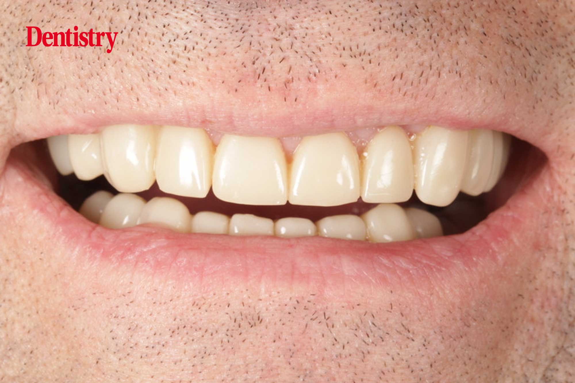 Full-mouth rehabilitation of a severe tooth wear case - Dentistry