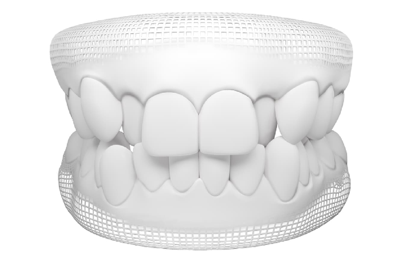 How to diagnose and treat dental crowding - Dentistry