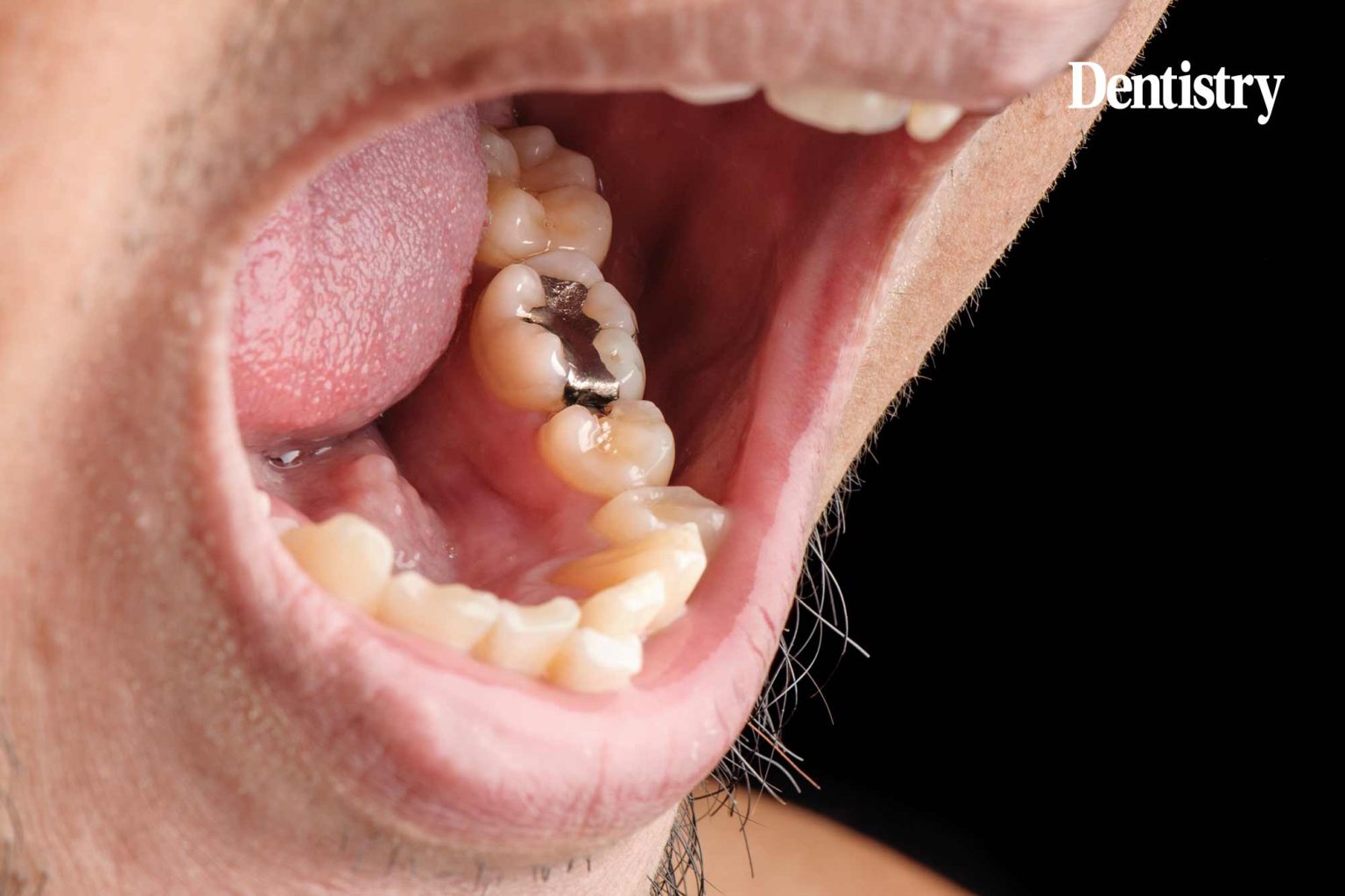 Dental amalgam: agreement sets global 'phase-out date' for 2034 - Dentistry.co.uk