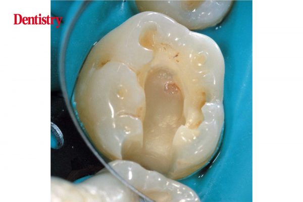 Biodentine – not just for special occasions - Dentistry